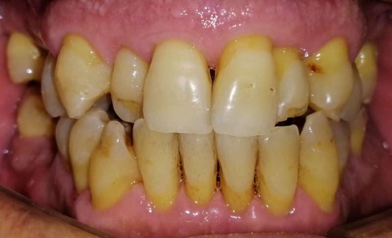 Caso clínico COR: enfermedad periodontal severa