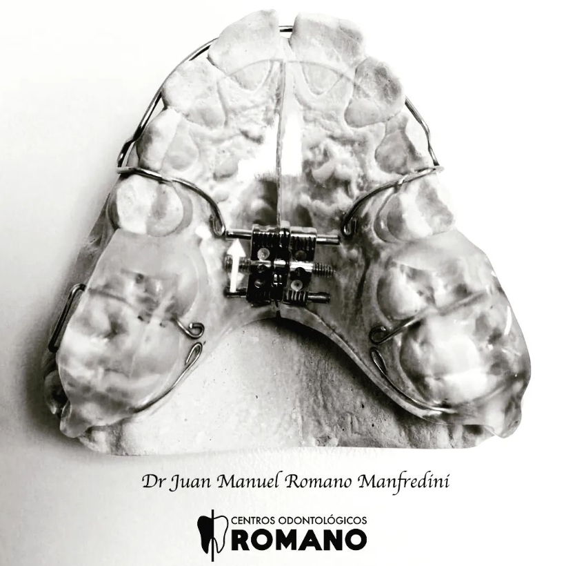 💙 PLACAS DE EXPANSIÓN 🦷 - Dentista en Alicante