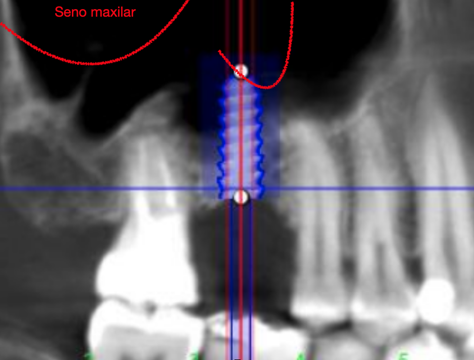 Elevación de seno maxilar, solución para implantes sin disponibilidad ósea